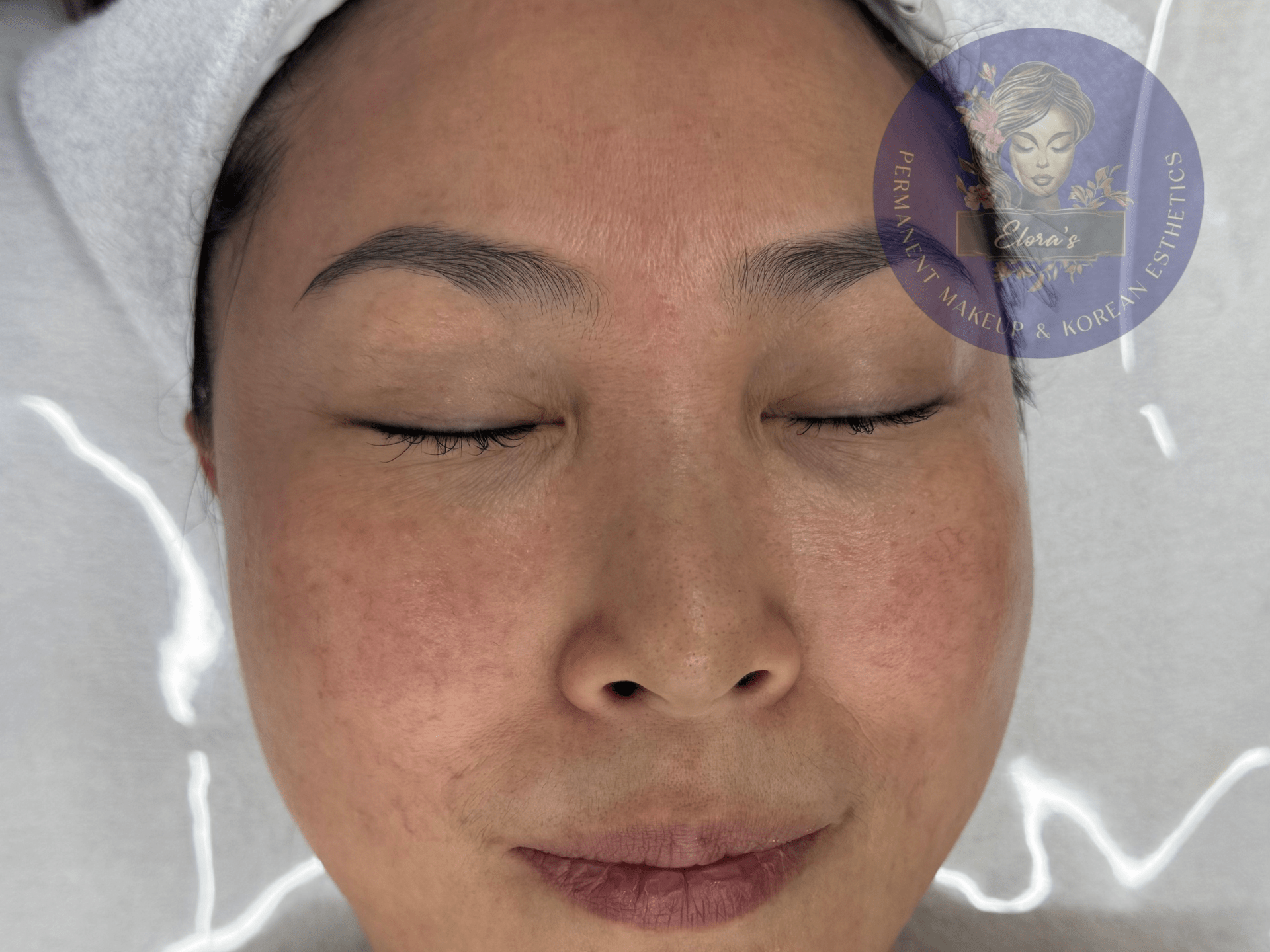 Microneedling with Korean Serums - Elora Beauty