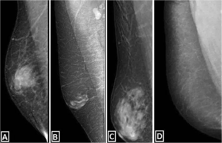 Radiology of Gynecomastia | Articl.net